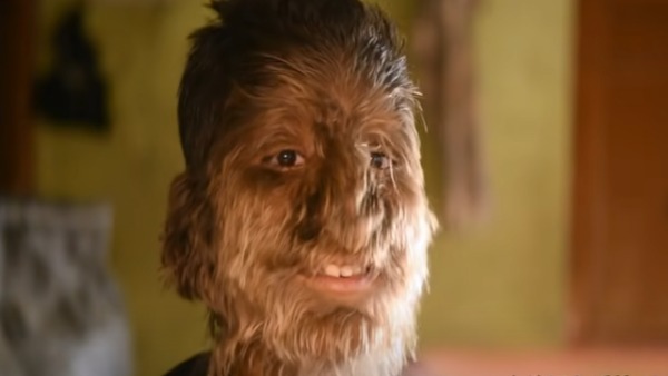 'भेड़िए की शक्ल' का इंसान! डर जाते हैं बच्चे, दुनिया के 50 लोगों में ...